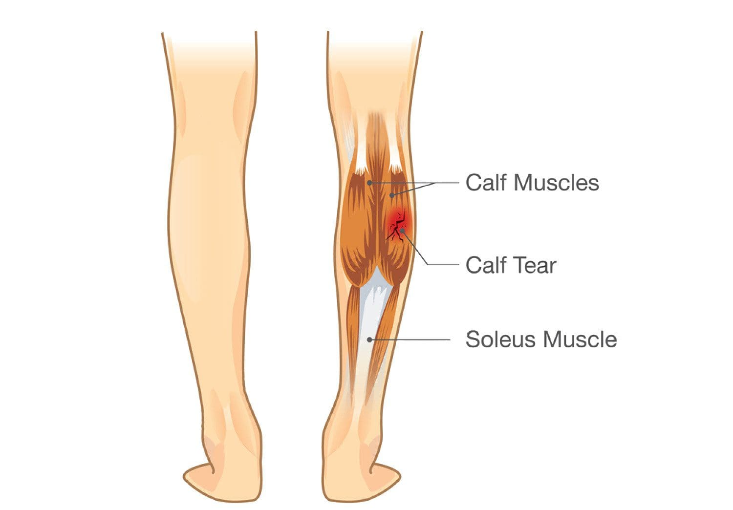Calf muscle tear El Paso s Injury Doctors 915 850 0900