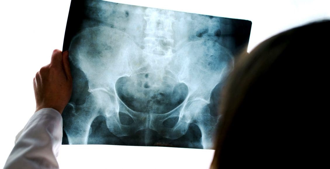 Diagnóstico por imágenes agudas de la pelvis y el traumatismo de la ...