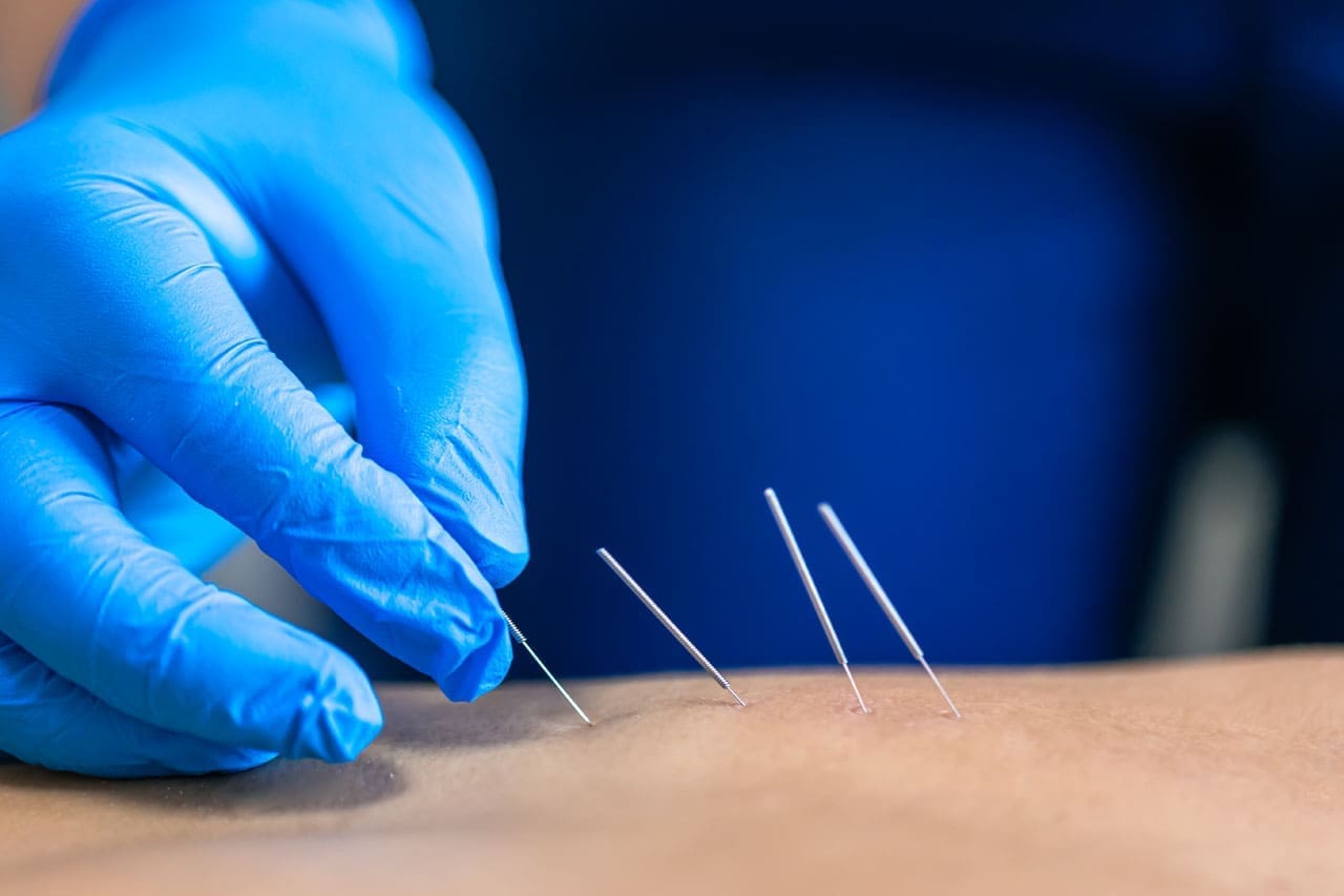 Acupuncture for Arthritis: What You Need to Know - El Paso's Personal ...